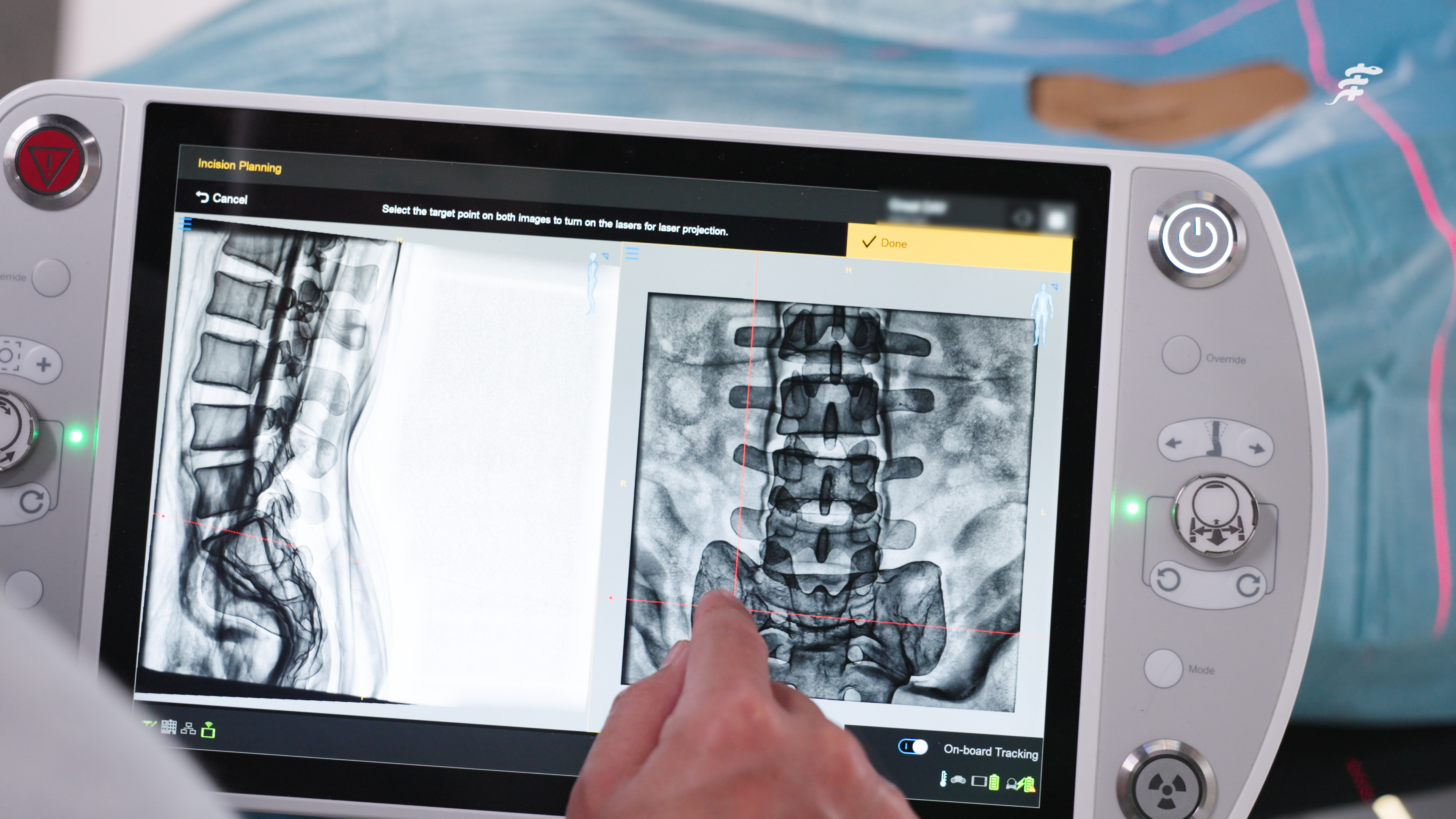 Experience Loop-X®: Mobile Robotic Imaging | Brainlab